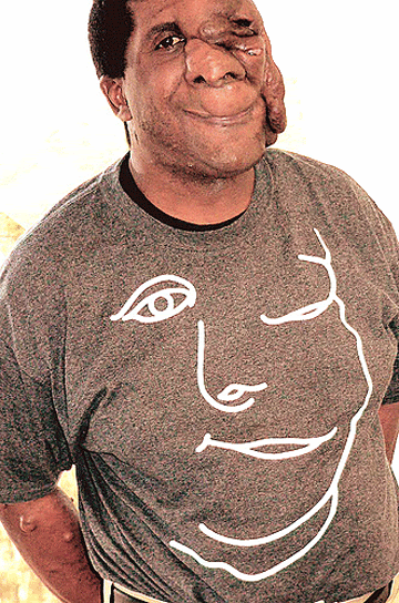 Neurofibromatosis Videos | Photobucket